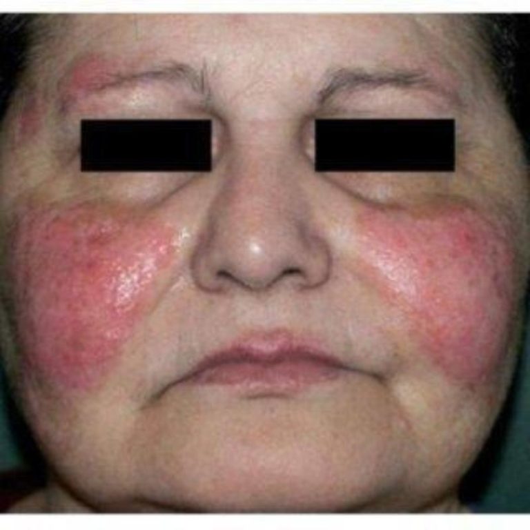 Entendendo o Lúpus Eritematoso Cutâneo