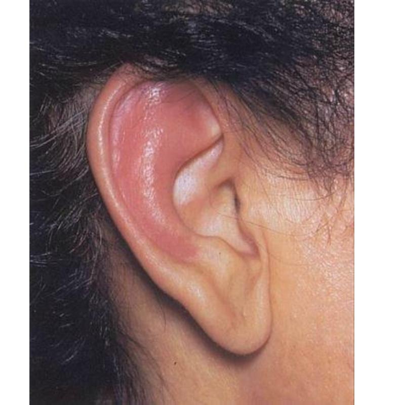 Policondrite Recidivante, uma revisão!